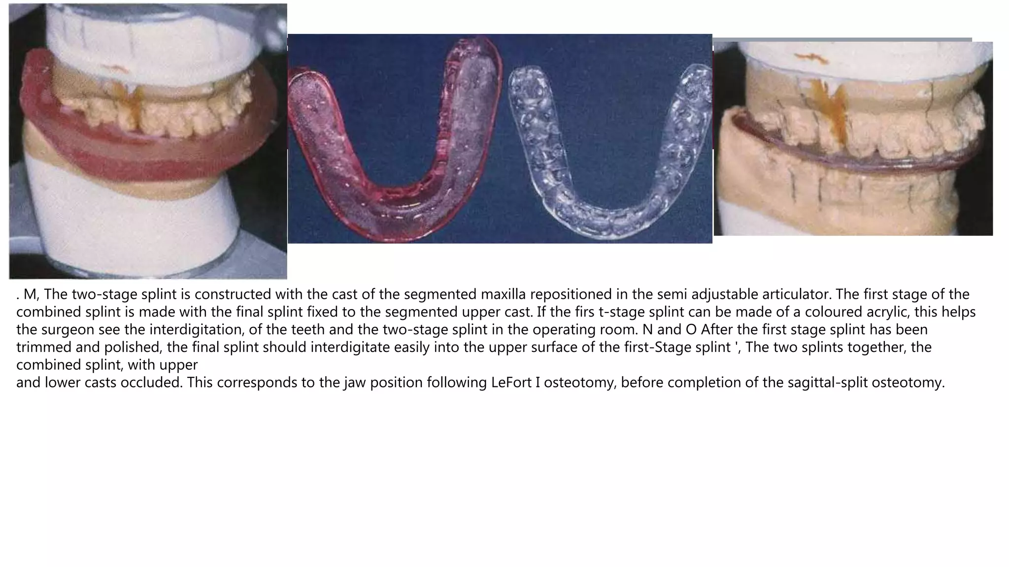 bimaxillary surgery.pptx
