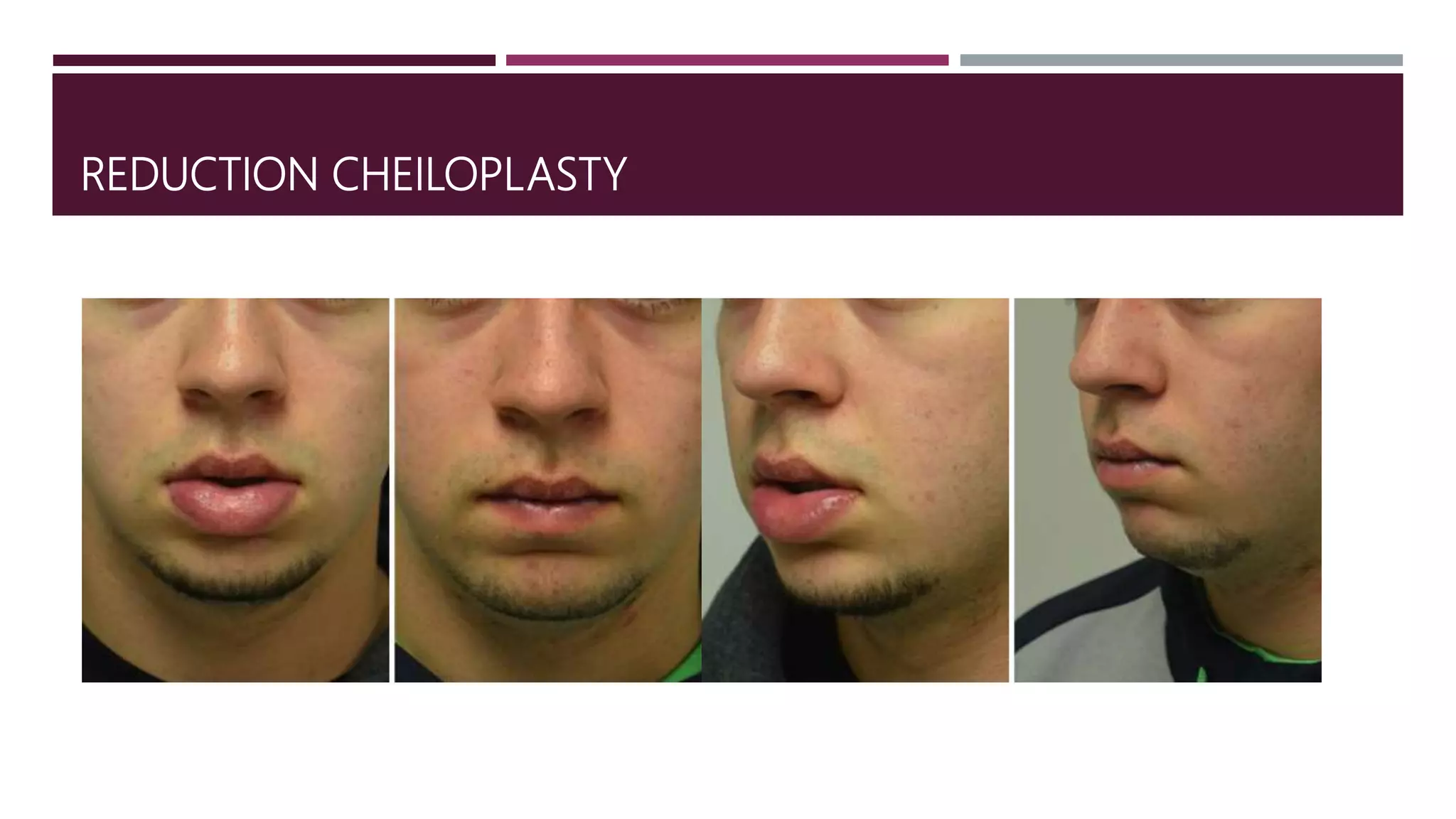 bimaxillary surgery.pptx