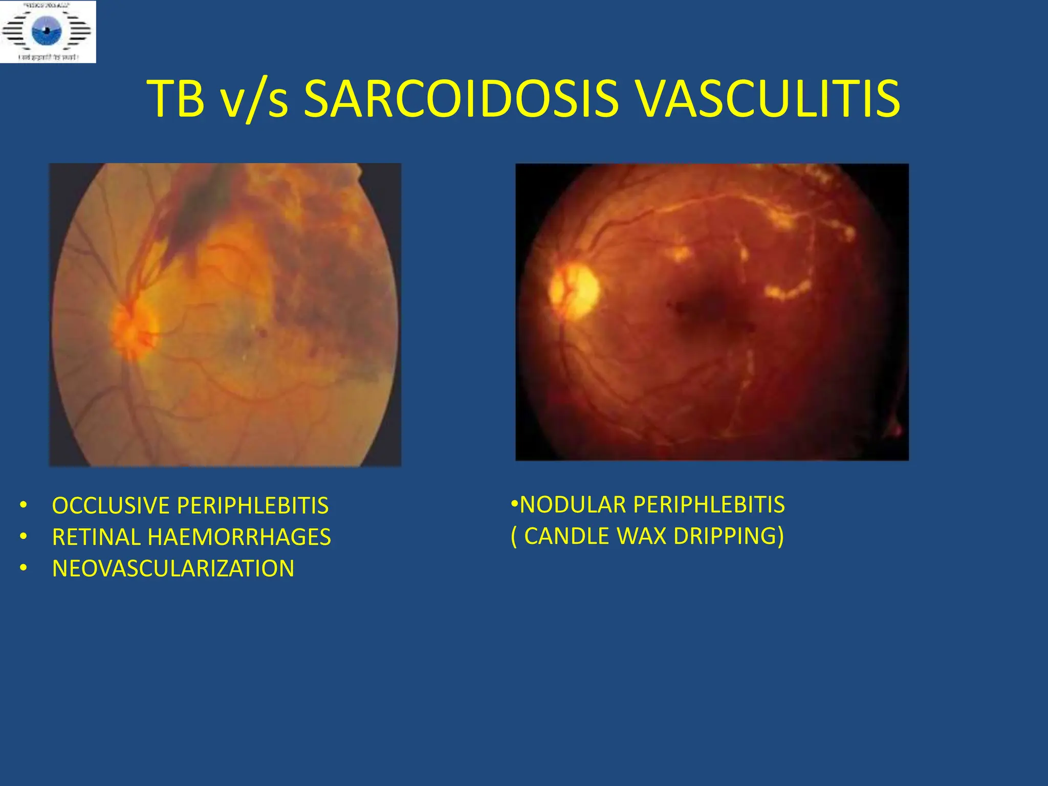 POST_UVEITIS_FINAL resentation dhir hospital bhiwani.pptx