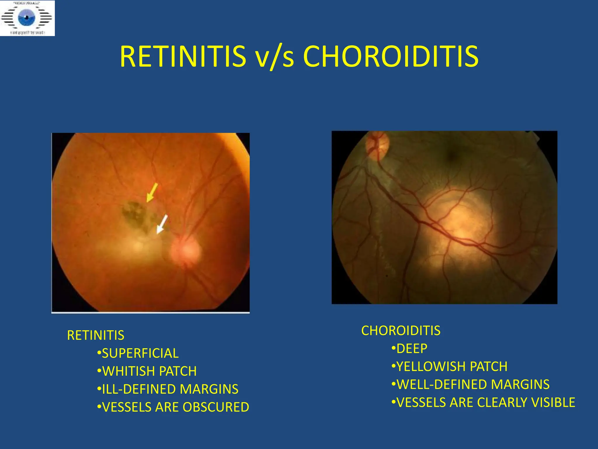 POST_UVEITIS_FINAL resentation dhir hospital bhiwani.pptx