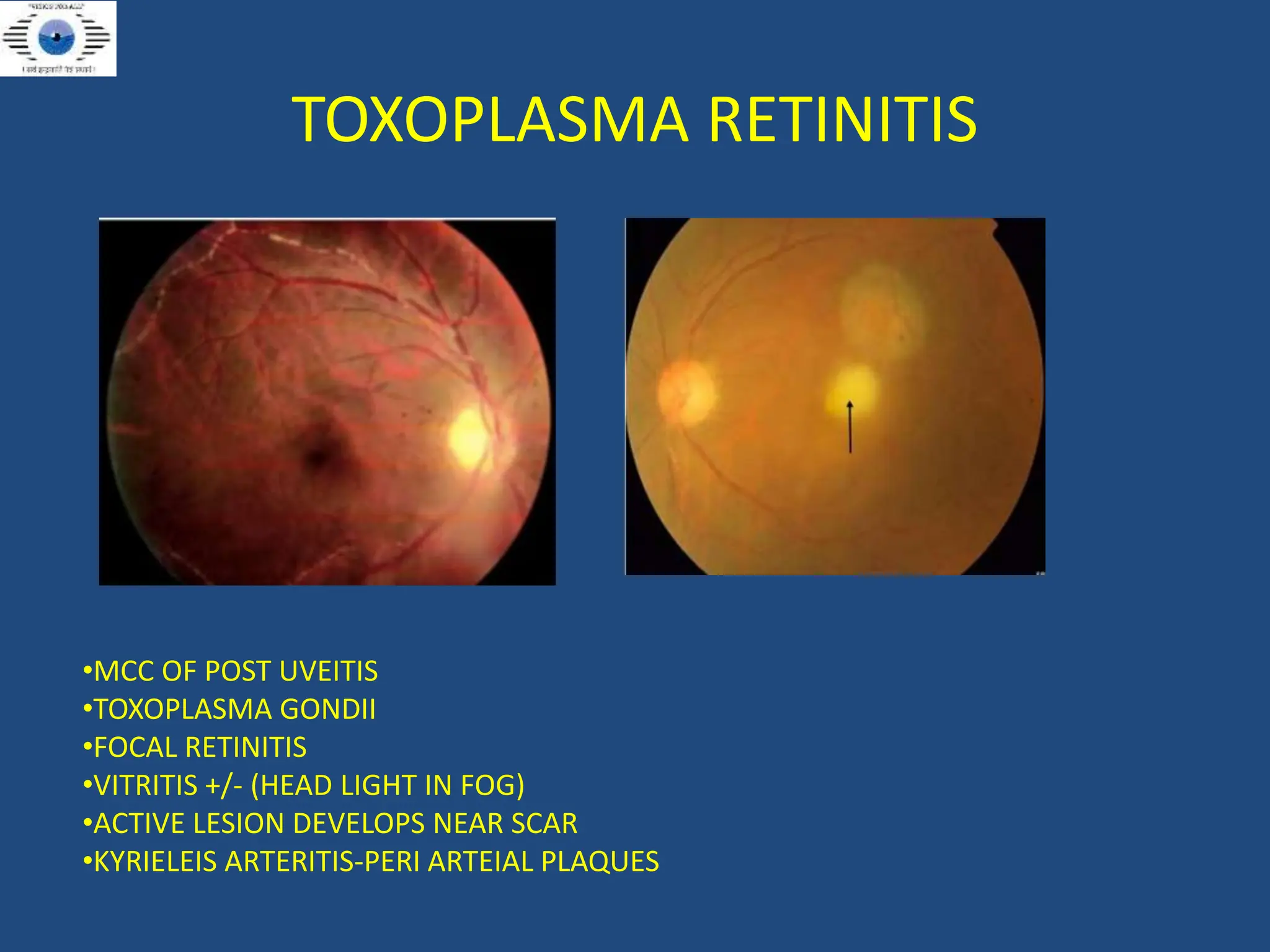 POST_UVEITIS_FINAL resentation dhir hospital bhiwani.pptx
