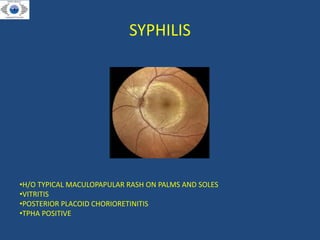 POST_UVEITIS_FINAL resentation dhir hospital bhiwani.pptx