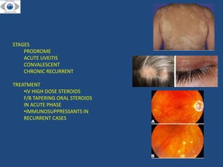 POST_UVEITIS_FINAL resentation dhir hospital bhiwani.pptx