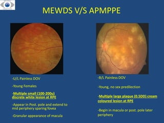 POST_UVEITIS_FINAL resentation dhir hospital bhiwani.pptx