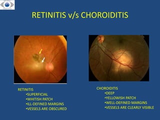 POST_UVEITIS_FINAL resentation dhir hospital bhiwani.pptx