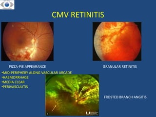 POST_UVEITIS_FINAL resentation dhir hospital bhiwani.pptx