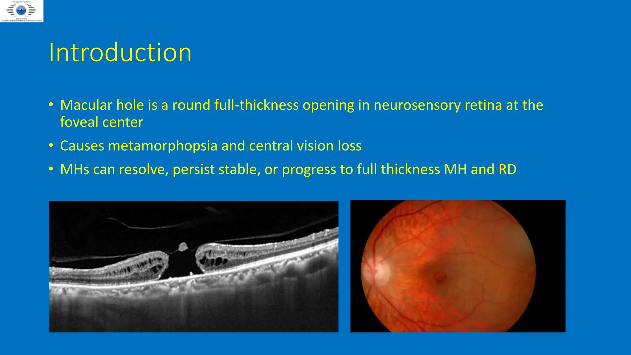 MACULAR_HOLE presentation dhir hospital bhiwani.pptx