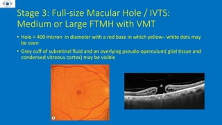 MACULAR_HOLE presentation dhir hospital bhiwani.pptx | Eye and Vision ...