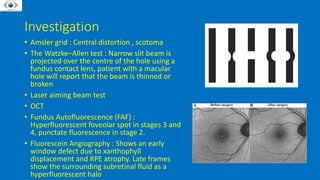 MACULAR_HOLE presentation dhir hospital bhiwani.pptx | Eye and Vision ...