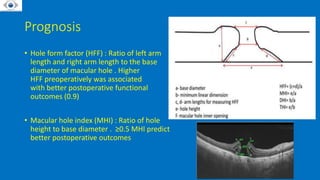 MACULAR_HOLE presentation dhir hospital bhiwani.pptx