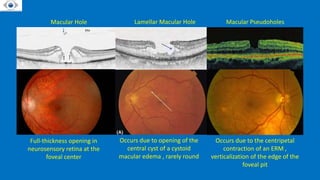 MACULAR_HOLE presentation dhir hospital bhiwani.pptx