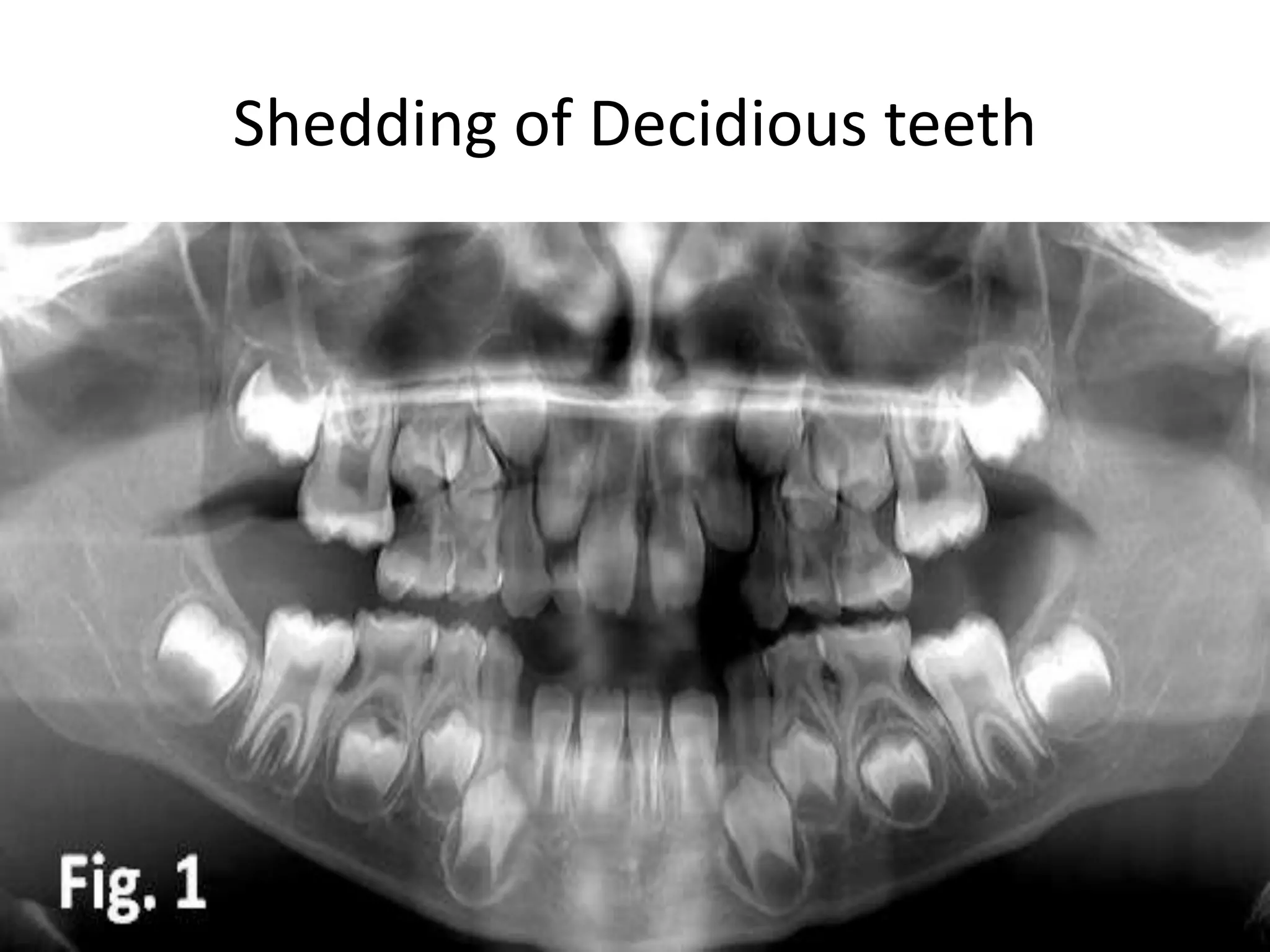 Tooth eruption and shedding - complete package | PPTX