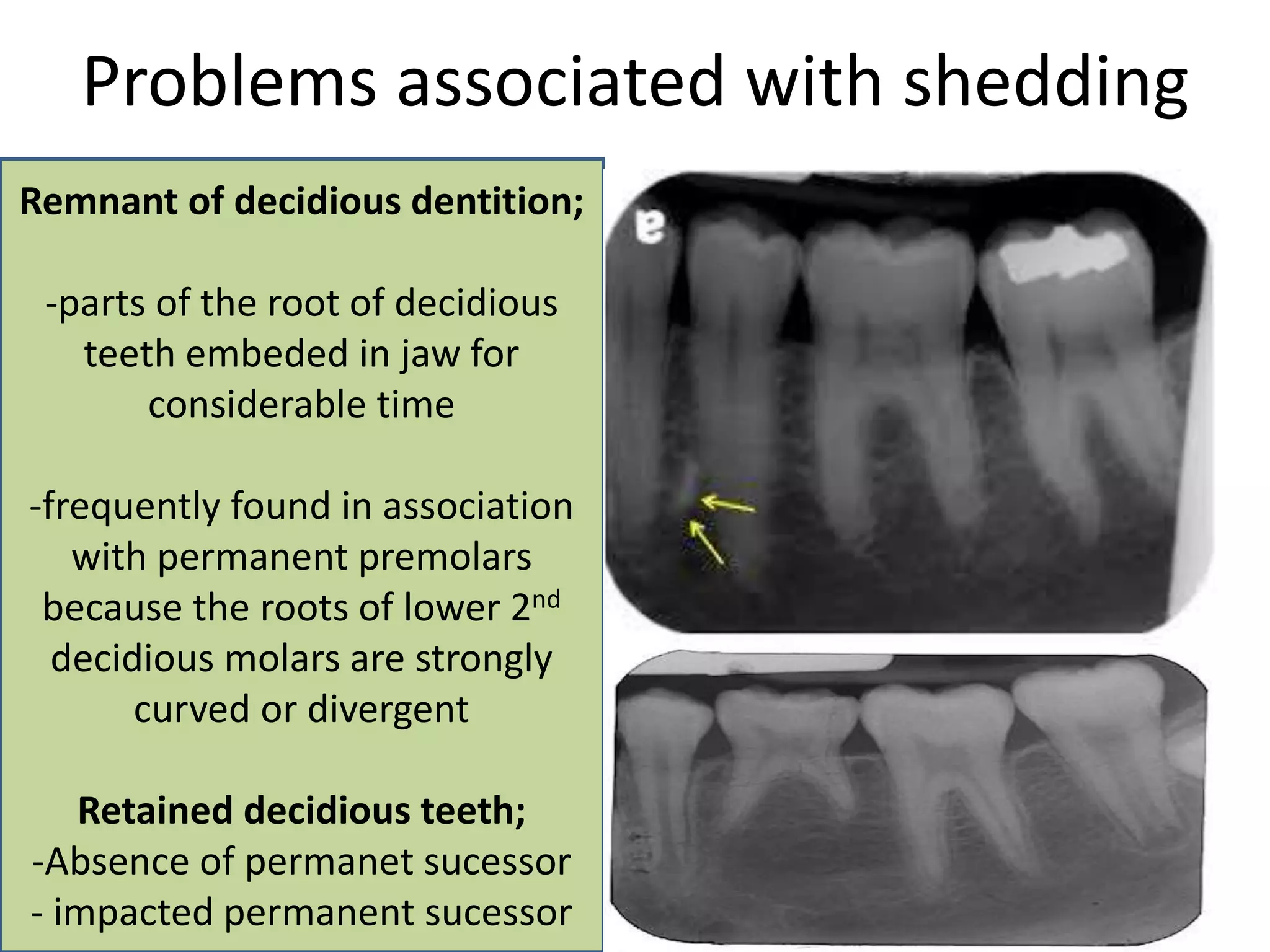 Tooth eruption and shedding - complete package | PPTX