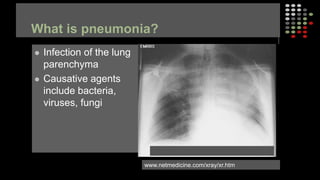 Comprehensive Overview of Pneumonia: Types, Pathophysiology, Diagnosis ...
