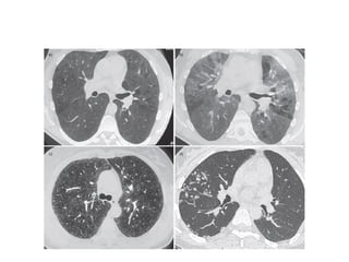 Bronchiolitis obliterans lecture definition and causes, treatment.pptx