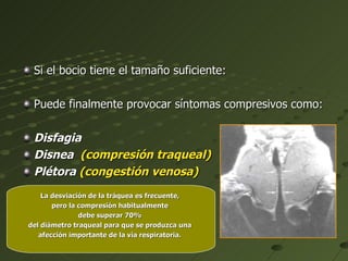 Bocio | PPT
