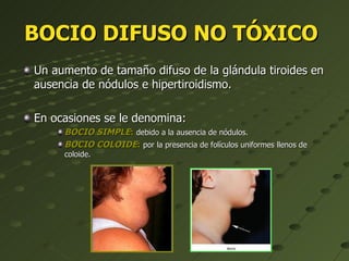 Bocio | PPT
