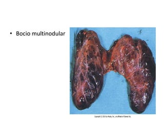 Bocio | PPTX
