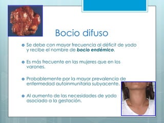 Bocio | PPTX