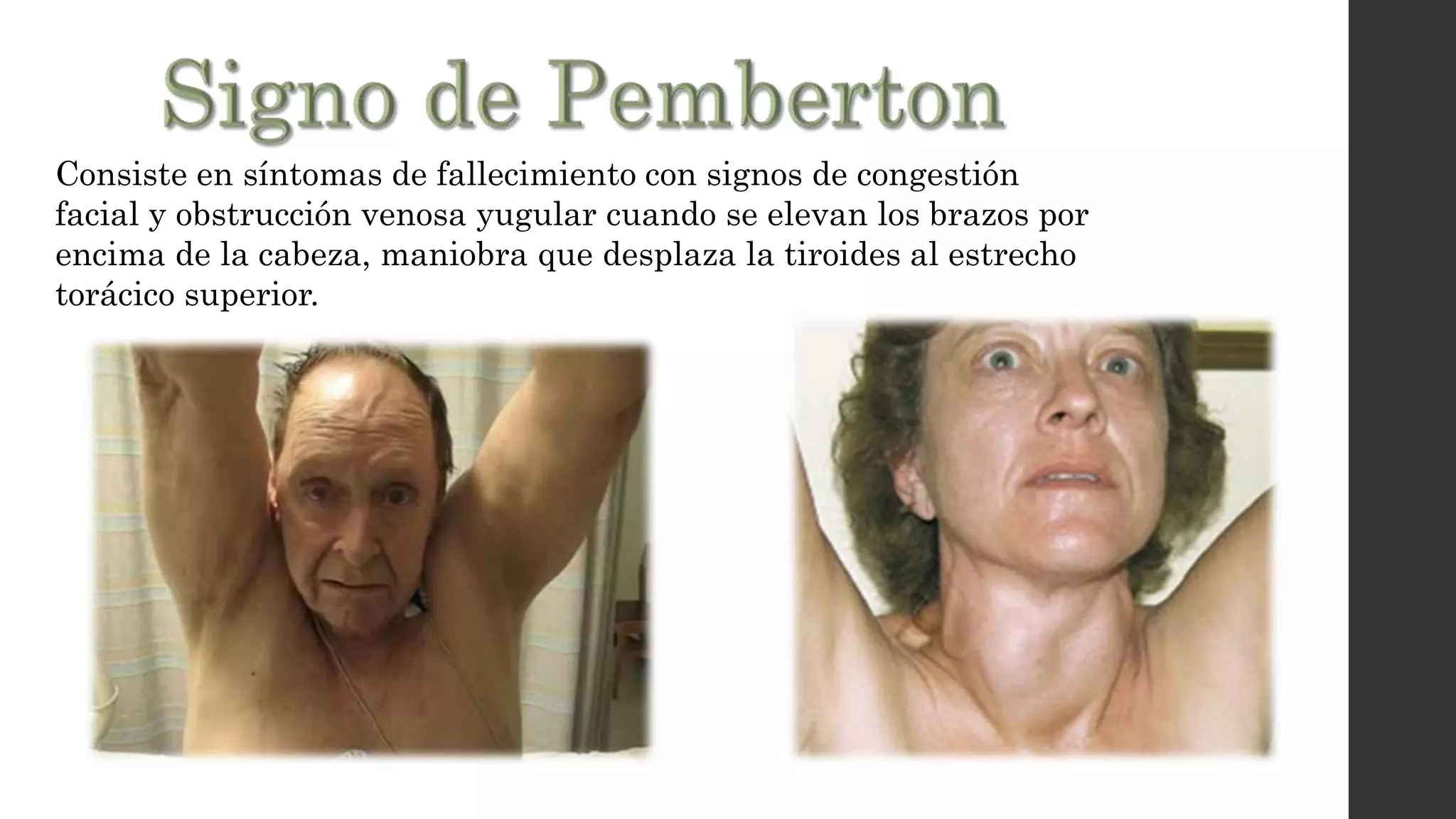 Bocio cuadro clinico