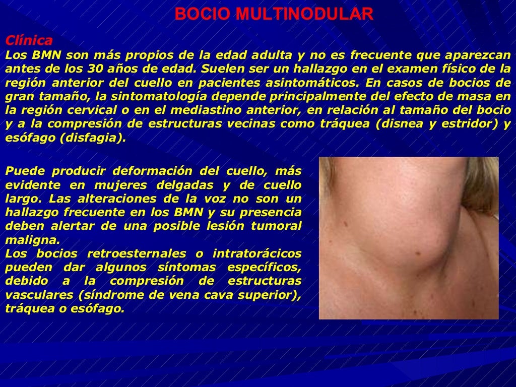 Bocio Multinodular é Cancer - BRAINCP