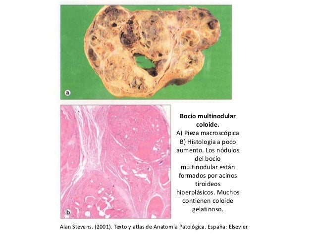 Bocio multinodular y difuso