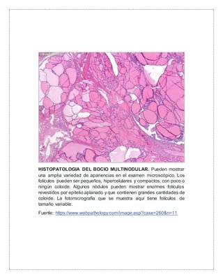 Bocio nodular | DOCX
