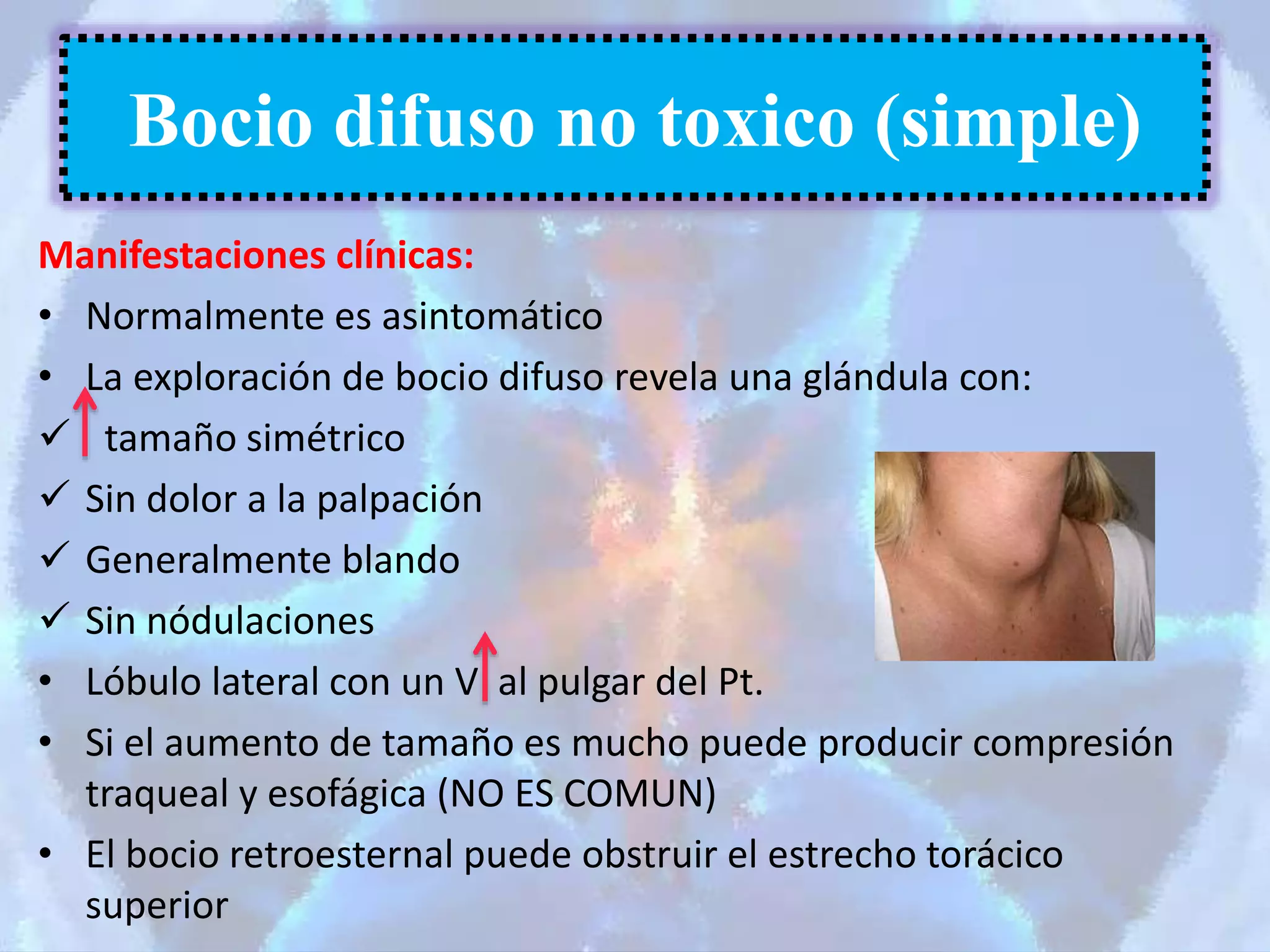 Bocio y enfermedad tiroidea nodular | PPT