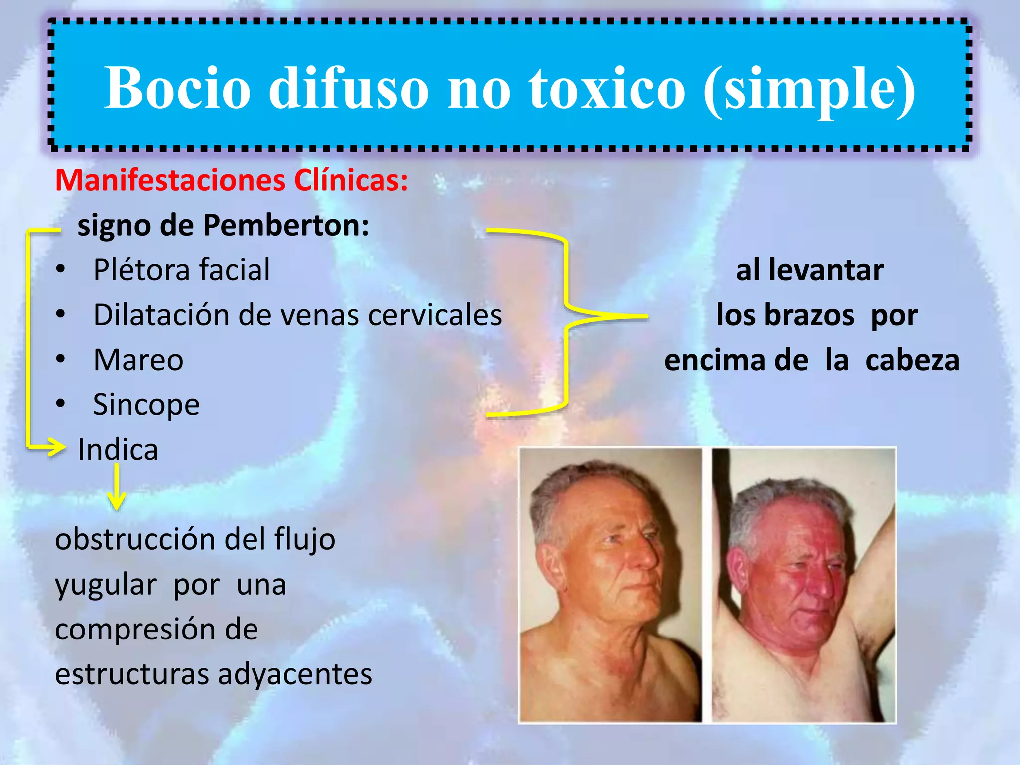 Bocio y enfermedad tiroidea nodular | PPTX