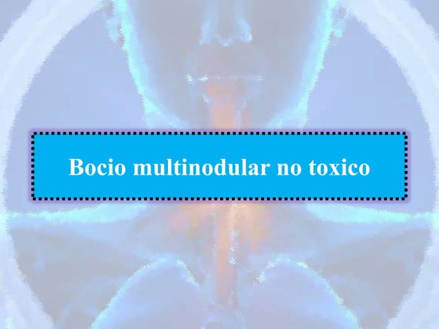 Bocio y enfermedad tiroidea nodular | PPTX