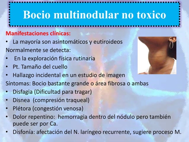 Bocio y enfermedad tiroidea nodular | PPTX
