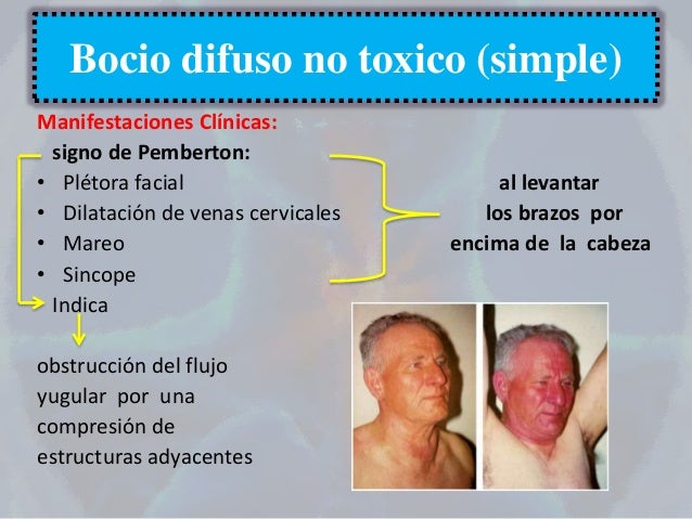 Bocio y enfermedad tiroidea nodular