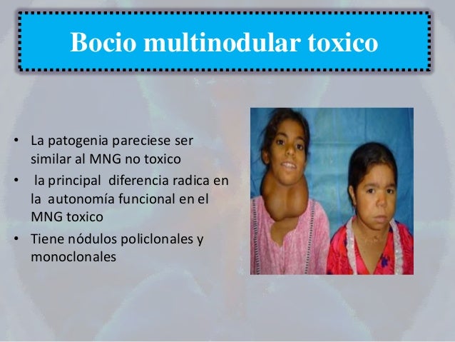 Bocio y enfermedad tiroidea nodular
