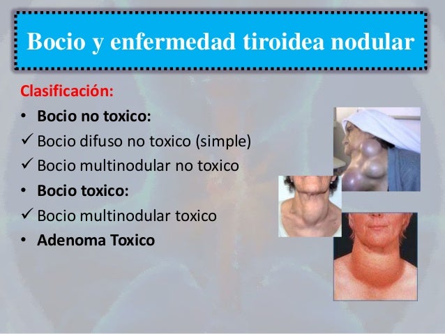 Bocio y enfermedad tiroidea nodular