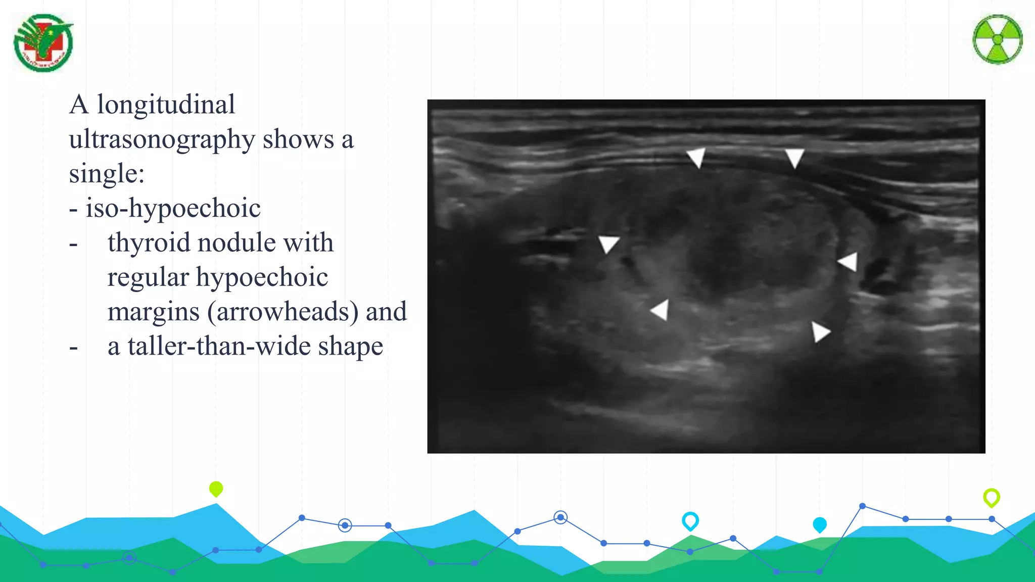 báo cáo TIRADS.pptx | Thyroid Disorders | Endocrine and Metabolic Diseases