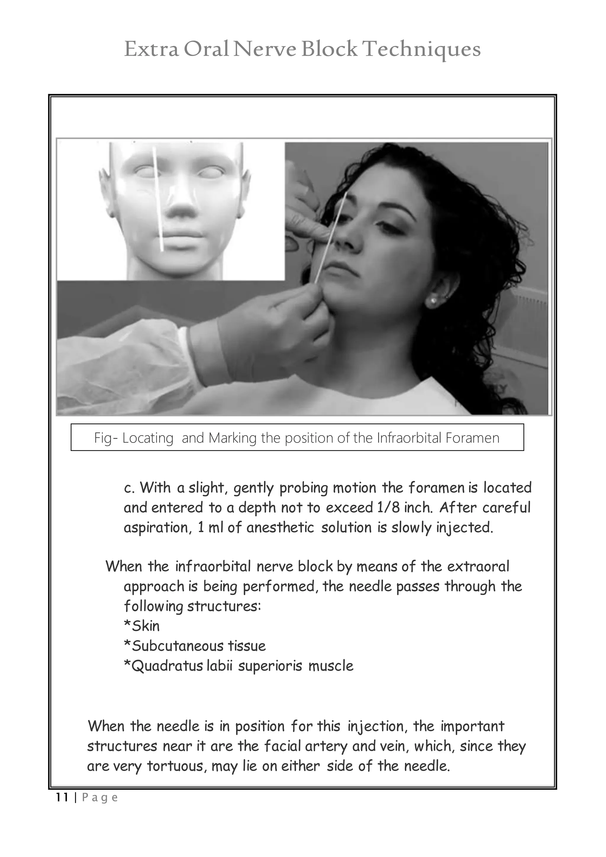 ExtraOral Nerve Block Techniques | DOCX