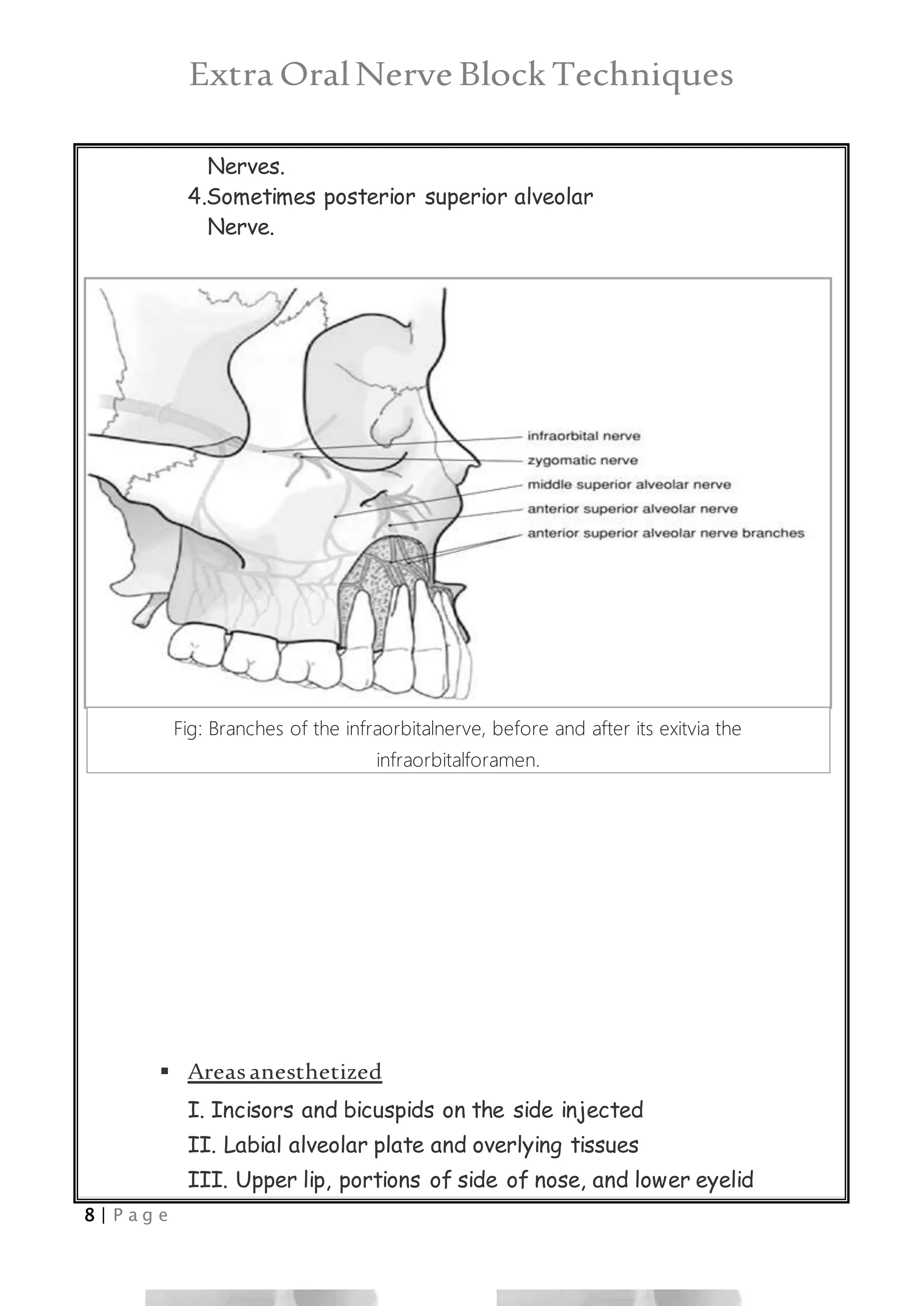 ExtraOral Nerve Block Techniques | DOCX