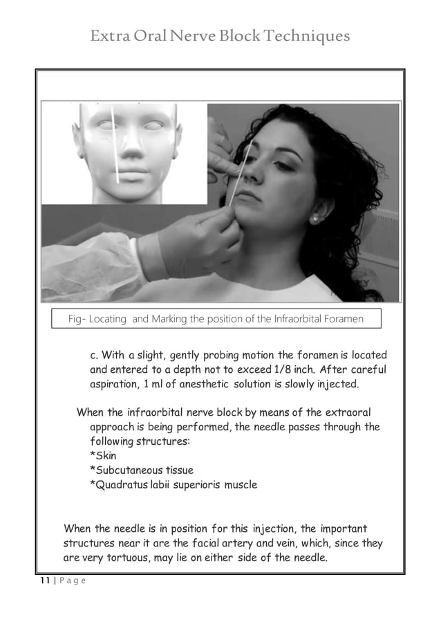 ExtraOral Nerve Block Techniques | DOCX