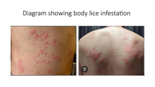 Body lice in adults and children in a society | PPTX