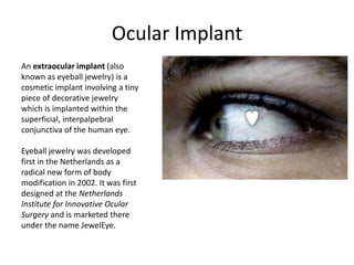 Extraocular Implant