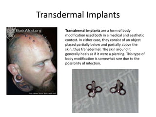 Transdermal Horns