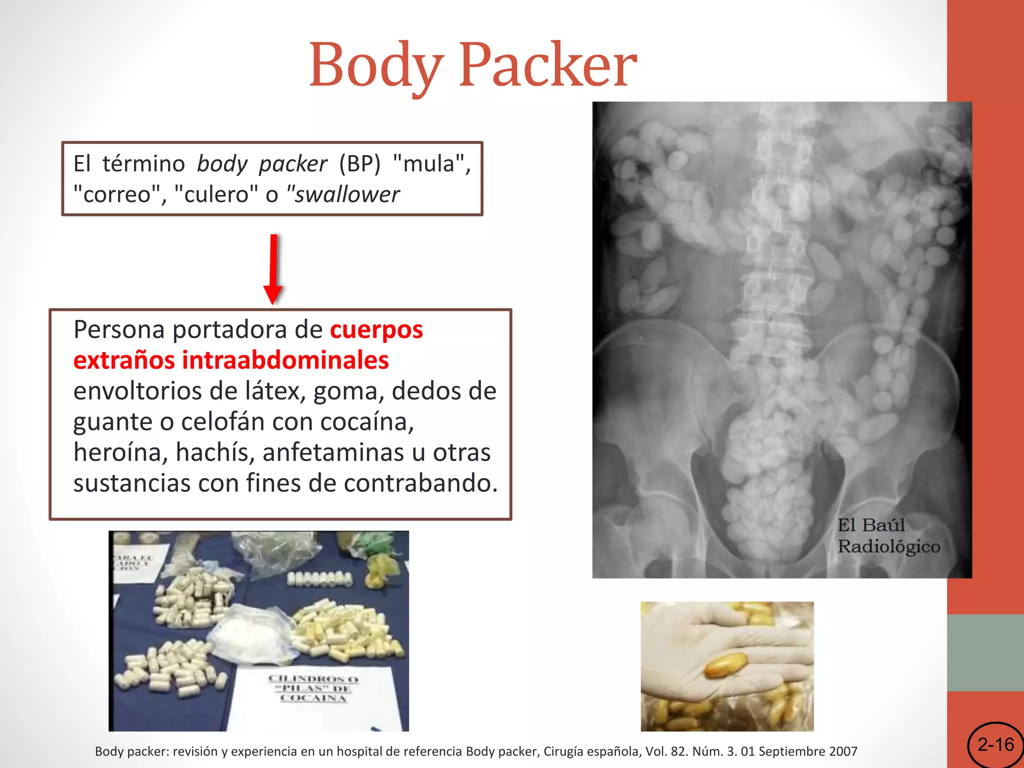 Body Packer | PPTX