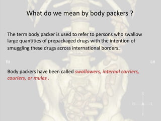 Body packers | PPTX