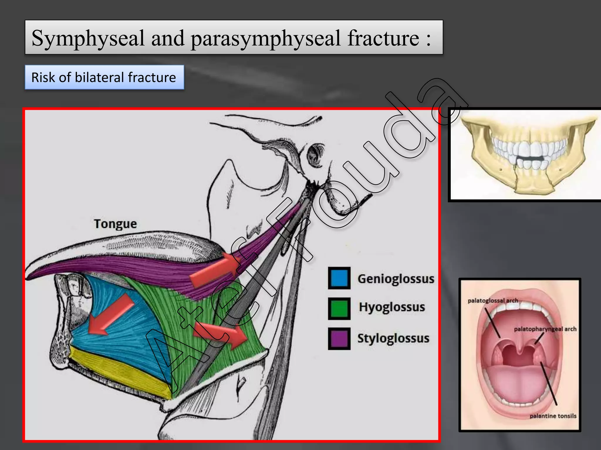 mandibular body,symph. and parasymph. fracture | PPSX