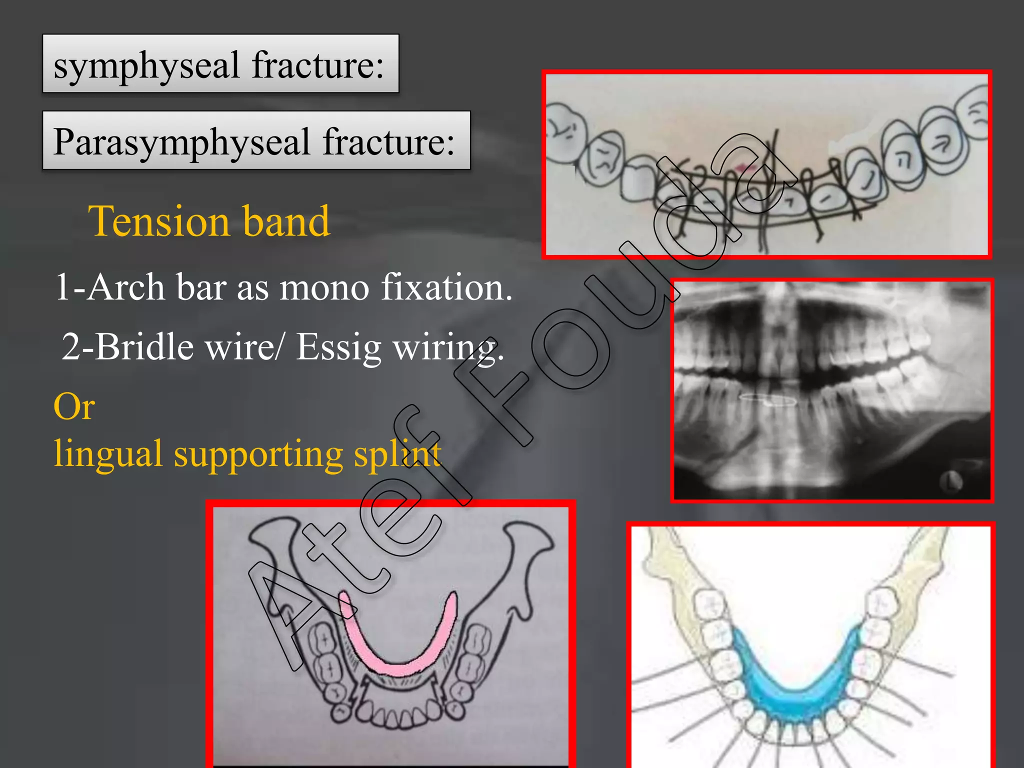 mandibular body,symph. and parasymph. fracture | PPSX