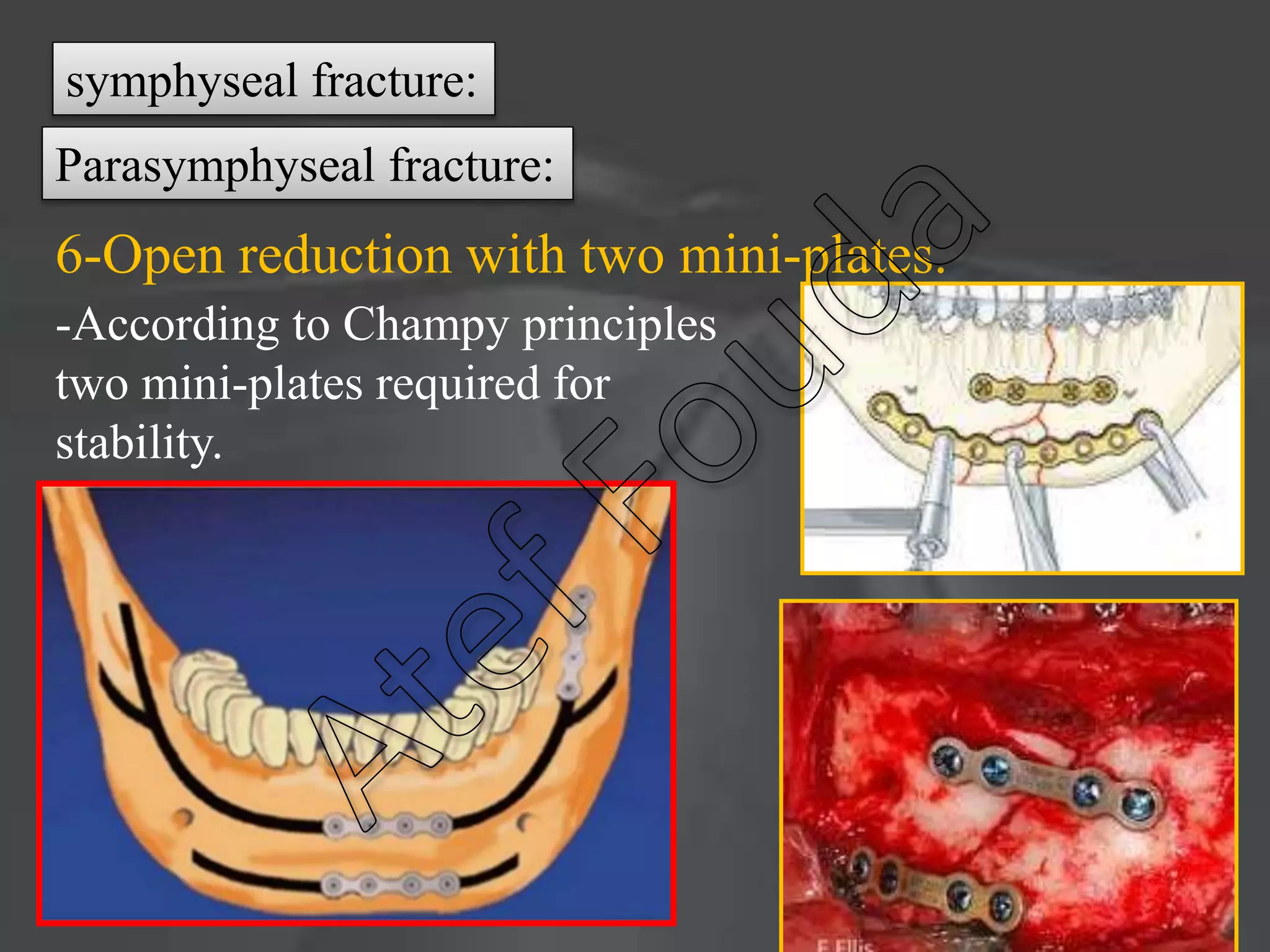 mandibular body,symph. and parasymph. fracture | PPT