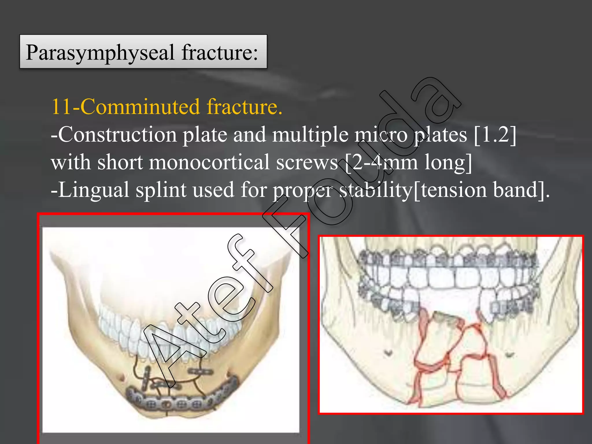 mandibular body,symph. and parasymph. fracture | PPSX