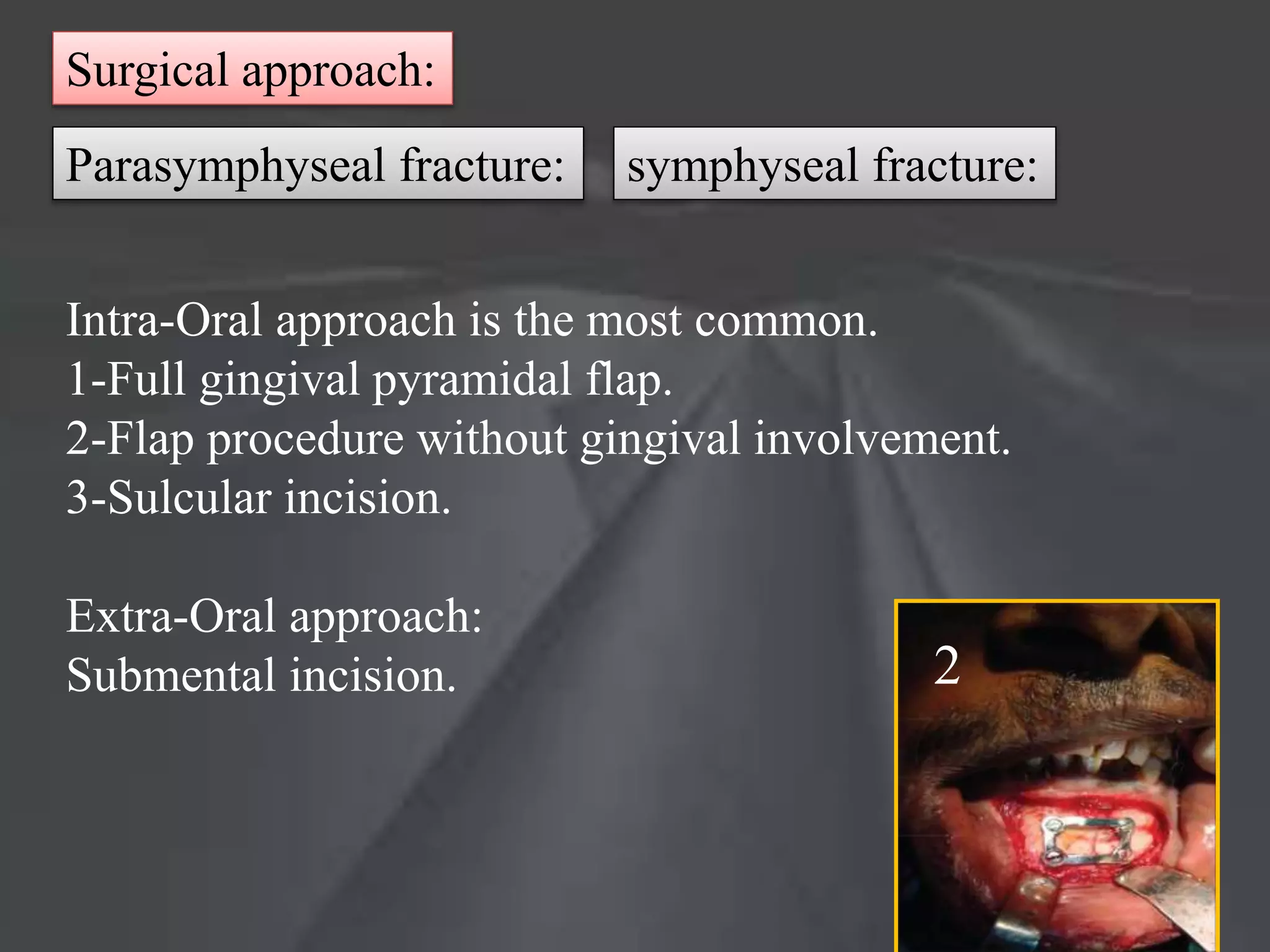 mandibular body,symph. and parasymph. fracture | PPSX