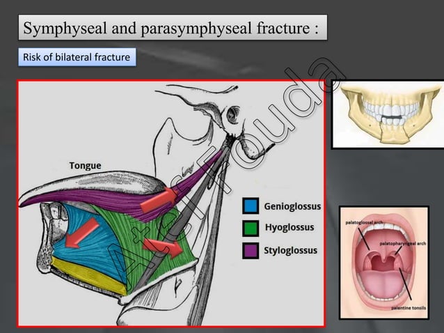 mandibular body,symph. and parasymph. fracture | PPSX | Physical ...