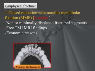 mandibular body,symph. and parasymph. fracture | PPSX